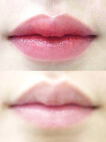 Lip Microblading in Korea - Three Wishes Clinic in Myeongdong