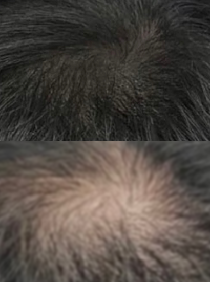 Hairline & Scalp Microblading in Korea - Three Wishes Clinic in Myeongdong