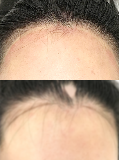 Hairline & Scalp Microblading in Korea - Three Wishes Clinic in Myeongdong