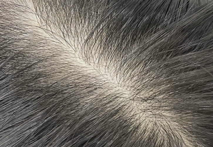 Hairline & Scalp Microblading in Korea - Three Wishes Clinic in Myeongdong